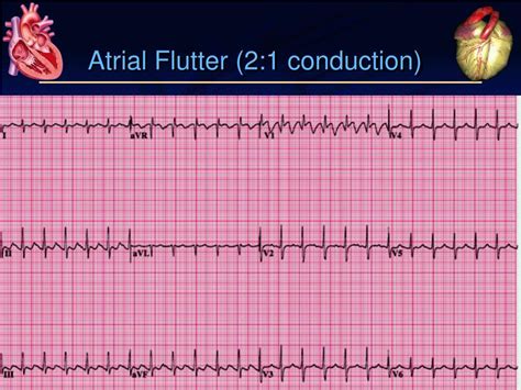 Atrial Flutter With 11 Conduction And Rate Dependent Vrogue Co