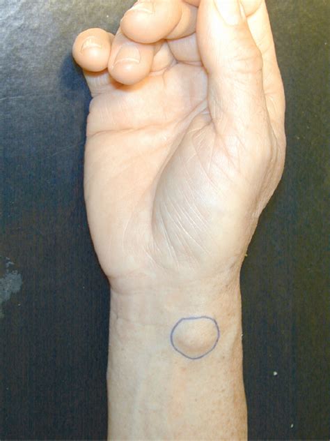 Chapter 5 Arthroscopic Excision Of Volar Wrist Ganglia