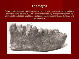 1 1 Antecedentes Históricos De La Prótesis Bucal 2009 Pps