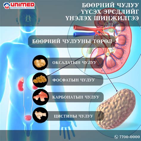 БӨӨРНИЙ ЧУЛУУ ҮҮСЭХ Unimed International Hospital