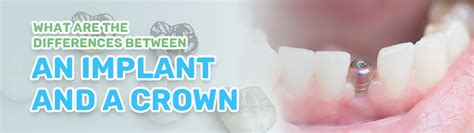 Platinum Teeth Implants