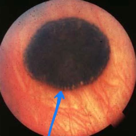 Retina Miscellaneous Retinal Lesions Flashcards Quizlet