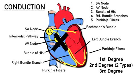Heart Block Types Causes Symptoms And Risk Factors 51 Off