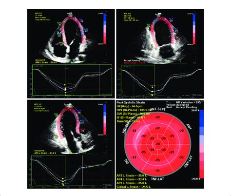 Left Ventricular Global Longitudinal Strain Lv Gls Measurement By Download Scientific