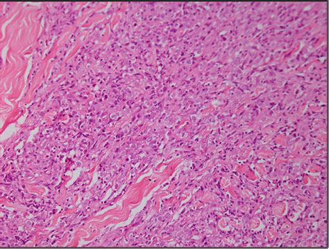 Anaplastic Lymphoma Kinase Alk Negative Systemic Anaplastic Large