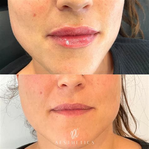 Lip Enhancement Treatments Gold Coast Dc Aesthetics