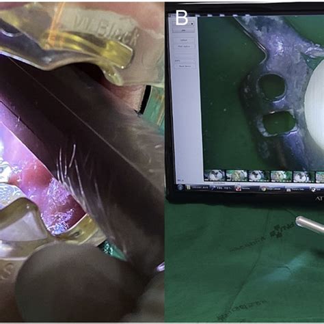 The Third Generation Quantitative Light Induced Fluorescence Equipment Download Scientific