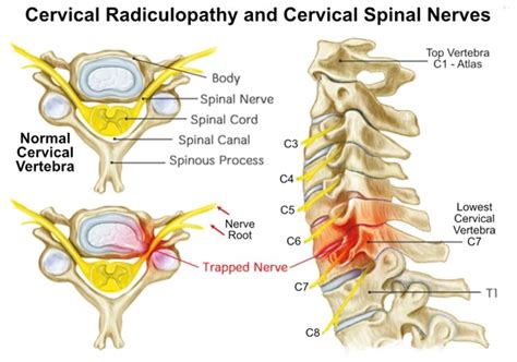 Cervical Spine Nerve Damage Pinched Nerve Dynamic Spine