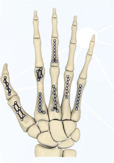 Hand Phalange Compression Plate Frc Series Aleda Medical Metacarpal Joint Locking Metallic