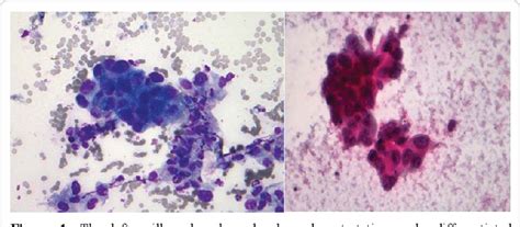 Figure 1 From A Rare Presentation Of Zosteriform Pattern Of Cutaneous Metastases From Lung