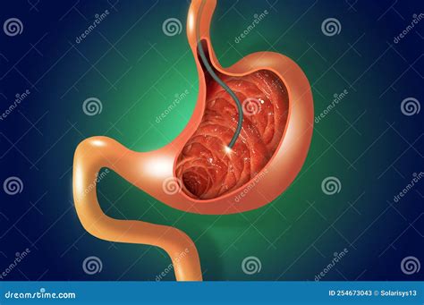 Digestive Endoscopy Or Gastroscopy Performing A Gastroscopy Procedure Diagnostics Of Gastric