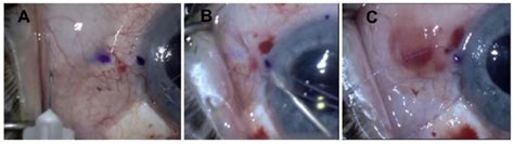 A Mixture Of Mitomycin C And Xylocaine 1 Is Injected Into