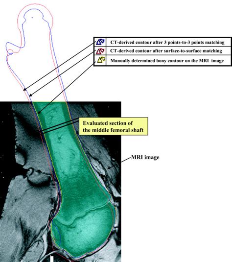 Local 2d Contour Based Measurement Of Matching Deviation In The Middle