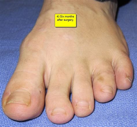 Part Ii British Hammertoes Are Wonky Toes” Before And After Pictures