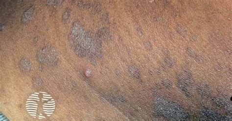 Pityriasis Versicolour Image