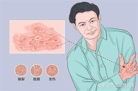 鱼鳞病有什么药？ 东莞肤康 知乎