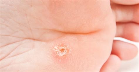 Hyperkeratosis Causes Symptoms And Treatment