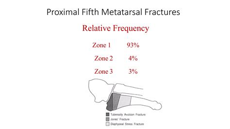 Foot Fractures Meta Tarsal Fractures Pptx