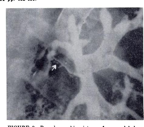Figure 2 From Bronchoscopic Criteria For The Diagnosis Of Tuberculous