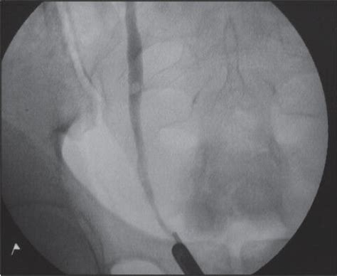 Retrograde Pyelogram Done Before Ureterorenoscopy Showing Filling Download Scientific Diagram