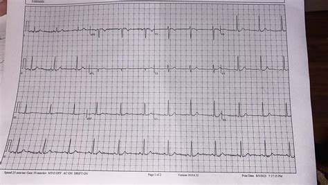 Heart Block Drs Said This Was A Normal Ekg… R Askcardiology