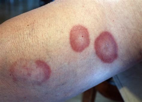 Granuloma Annulare Understanding The Skin Condition