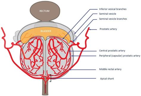 Jpm Free Full Text Prostate Artery Embolization Challenges Tips