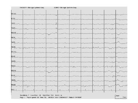 Normal Eeg Variants By Faizan Abdullah PPT