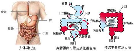 溃疡性结肠炎肠镜下图片 有来医生
