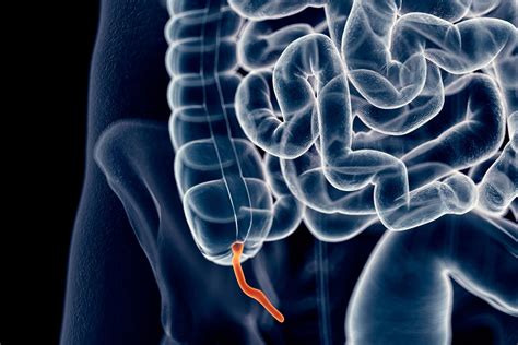 Appendix Diagram Location Ruptured Appendix Causes Symptoms