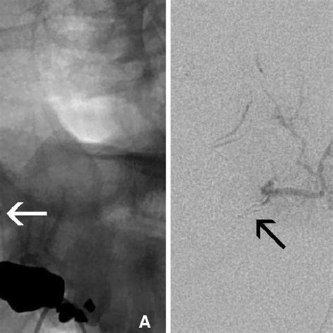 Pdf Improving Forward Infusion Pressure During Brain Tumor Embolization With The Double
