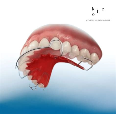 Metal Retainers Secure Retainers From 225 • Kohe™ Dental