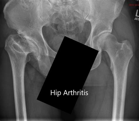 Abnormal Hip X Ray