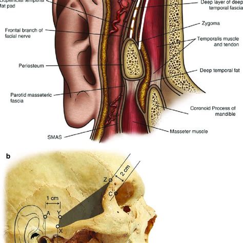 1 Scalp Flap A Layers Of The Scalp In The Temporal Region Dotted Download Scientific