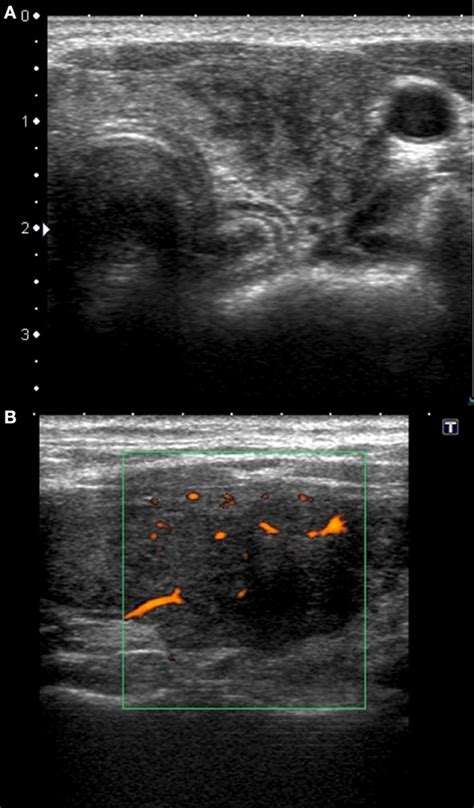 Sonographic Pattern Of Subacute Thyroiditis Is Hla Dependent Pmc