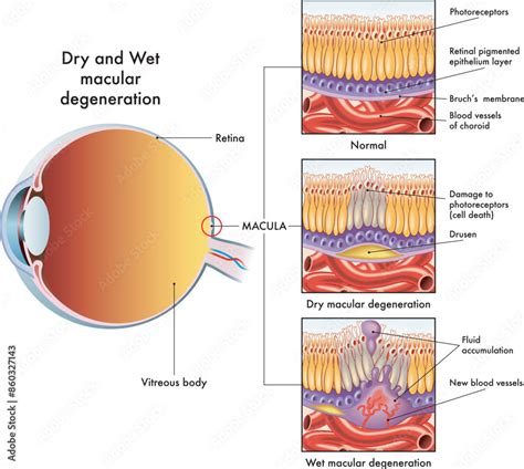 Medical Illustration Shows The Symptoms Affecting An Eye Affected By