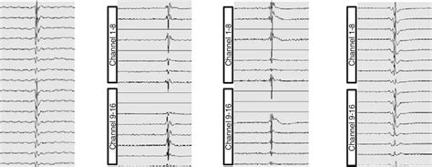 Representative Biphasic Waveform Recordings Representative Recordings Download Scientific