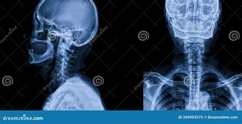 X Ray C Spine In Ap And Lateral View In Orthopedic Unit Inside Hospital Normal Radiology Stock