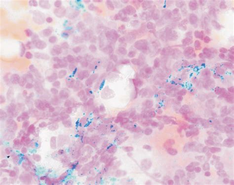 The Pattern Of Iron Staining Seen In A Patient Who Had Received
