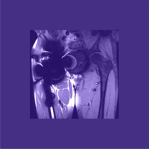 Mr Image Quality And Artifacts Truncation Gibbs Artifact E Mri