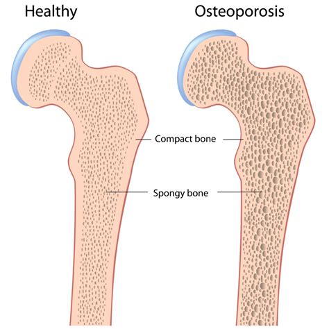 Five Early Signs Of Osteoporosis In Women Hypervibe Aus