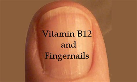 Vitamin D Deficiency Nails