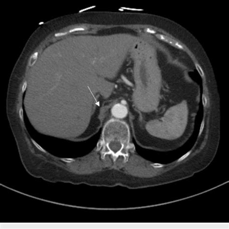 Axial Contrast Enhanced Ct Image Of Abdomenpelvis Demonstrates The Download Scientific Diagram
