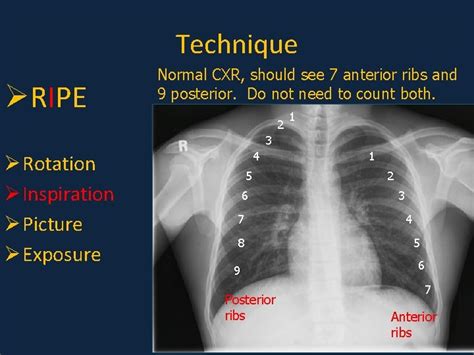 Part 2 0 Standardised Interpretation Of Paediatric Cxr