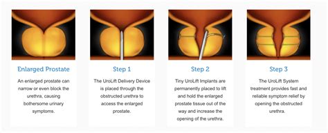 What Is Enlarged Prostate Size At Booker Zuniga Blog