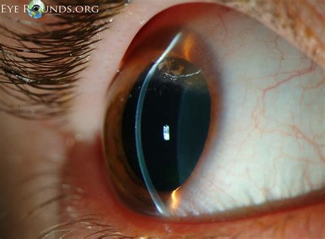 Atlas Entry Terrien Marginal Degeneration