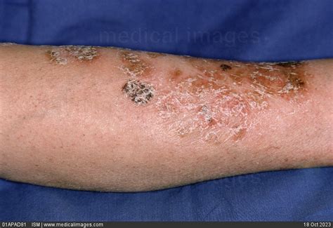 Stock Image Leg Exhibiting Phagedenic Pyoderma A Purulent Skin Disease