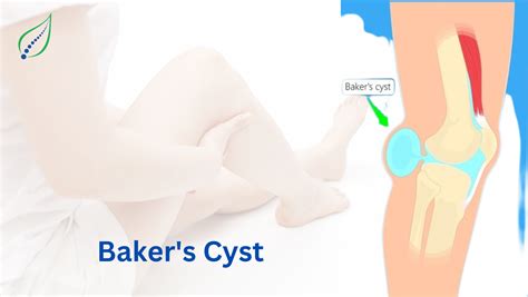 Bakers Cyst Symptoms Causes And Treatments Best Back Pain Slip