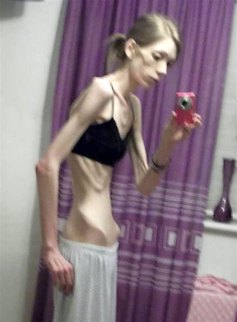 Transformation Four Stone Anorexic Into Champion Bodybuilder Health