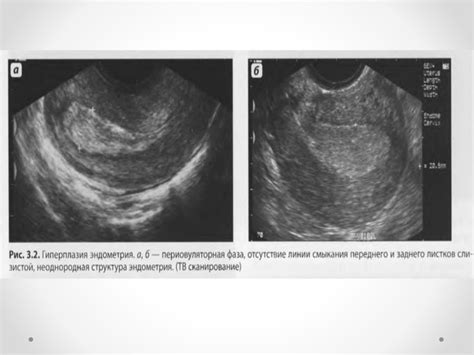 УЗИ Признаки гиперплазии эндометрия презентация онлайн
